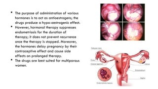 Treatment of endometribsbbsbdbbdbbennenbenrbbosis.pptx