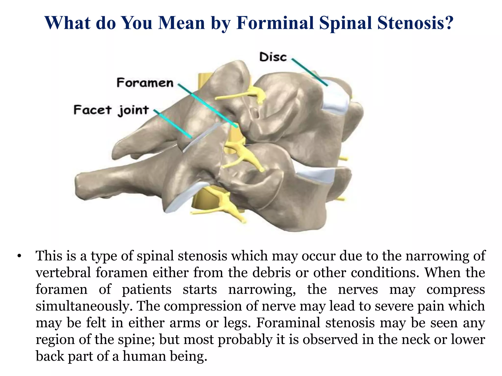 Treatment of foraminal stenosis | PPTX