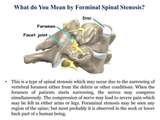 Treatment of foraminal stenosis | PPTX