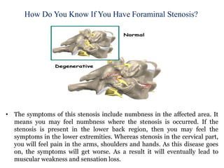 Treatment of foraminal stenosis | PPT
