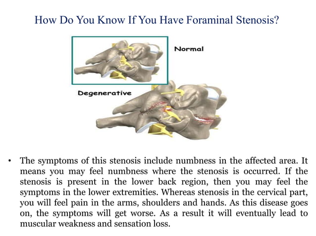 Treatment of foraminal stenosis | PPT