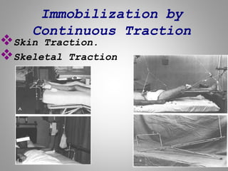 Treatment of fracture | PPTX