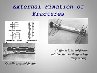 Treatment of fracture | PPTX