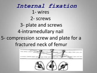 Treatment of fracture | PPTX