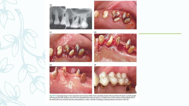 Treatment of furcation involved teeth / endodontics and periodontics | PPTX