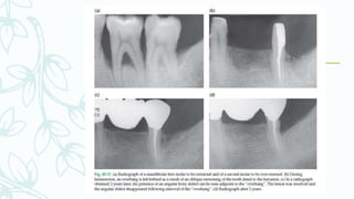 Treatment of furcation involved teeth / endodontics and periodontics | PPTX