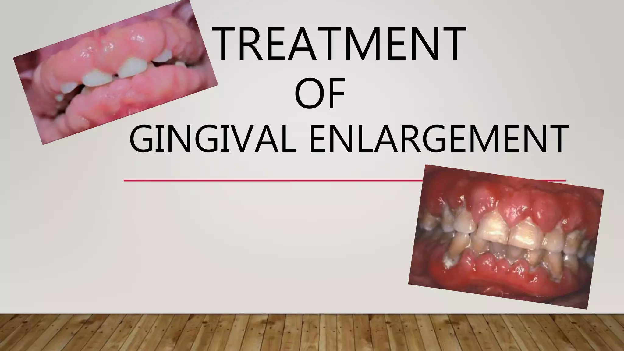 Treatment of gingival enlargement | PPTX
