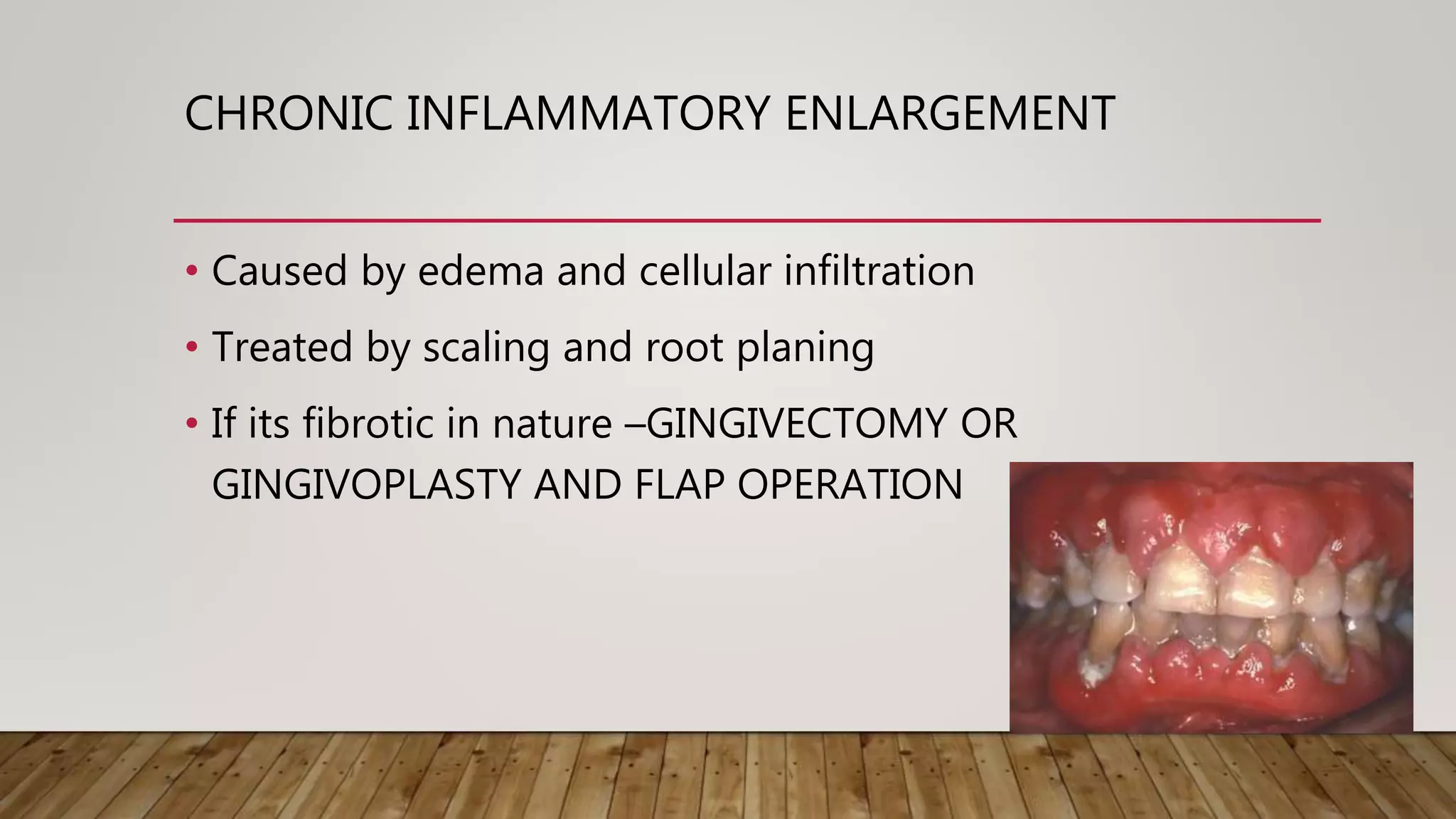 Treatment of gingival enlargement | PPTX