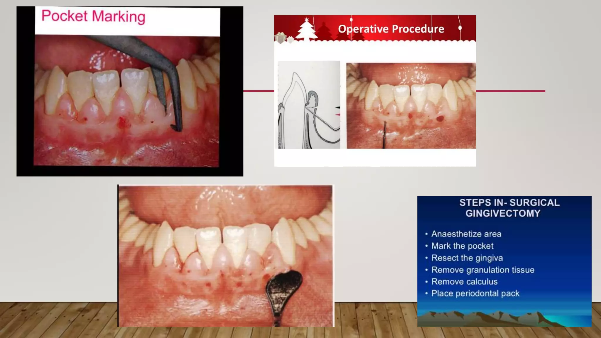 Treatment of gingival enlargement | PPTX