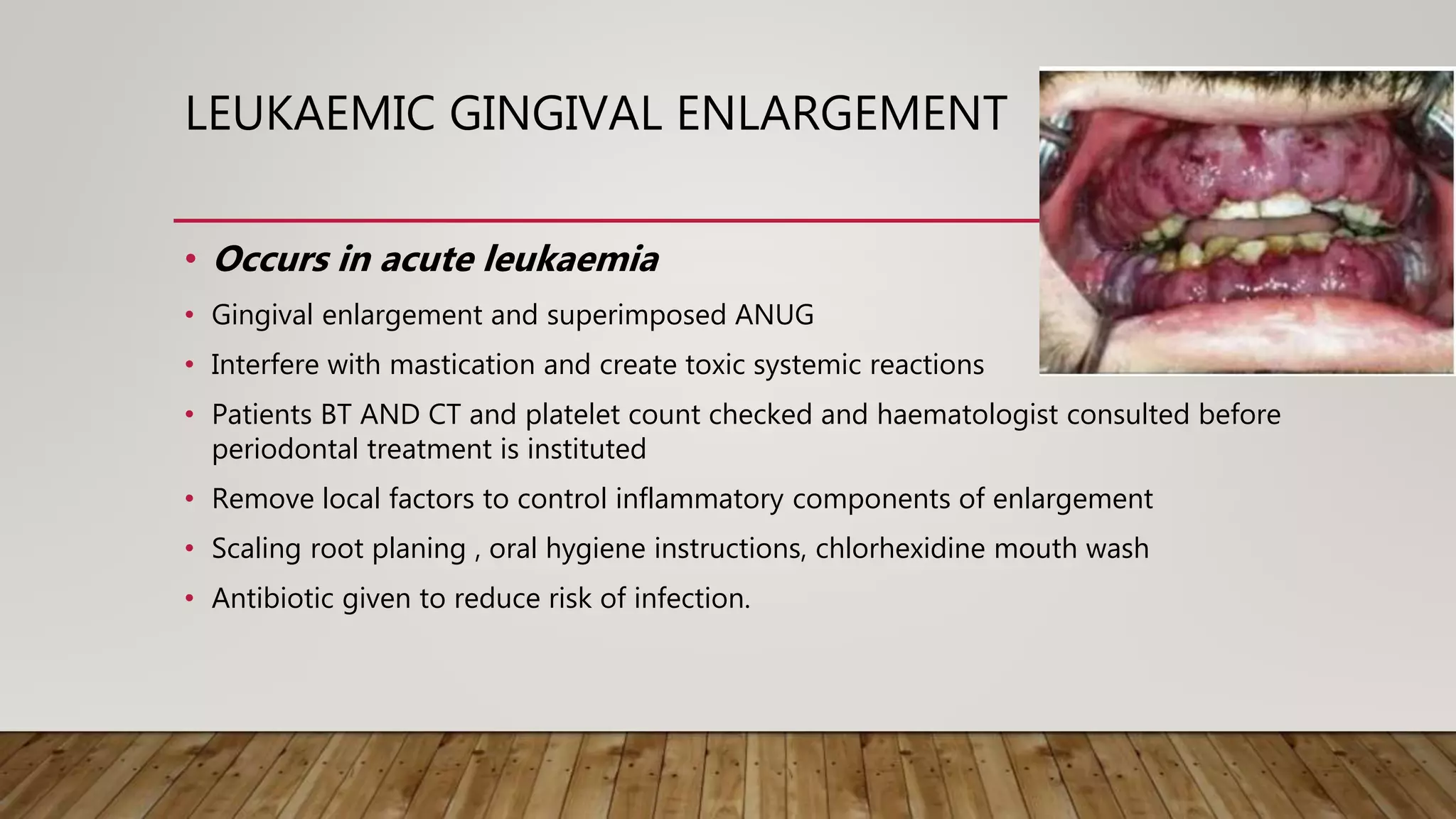 Treatment of gingival enlargement | PPTX