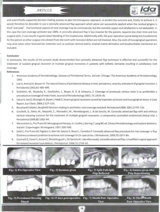 Treatment of gingival recession using coronally advanced flap | PDF