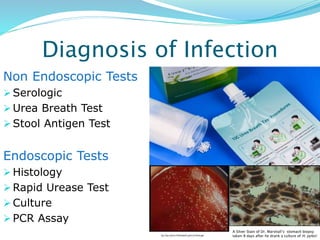 Treatment of Helicobacter pylori | PPTX