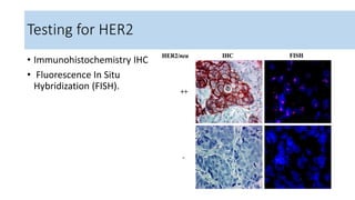 Treatment of her2 positive breast cancer | PPTX