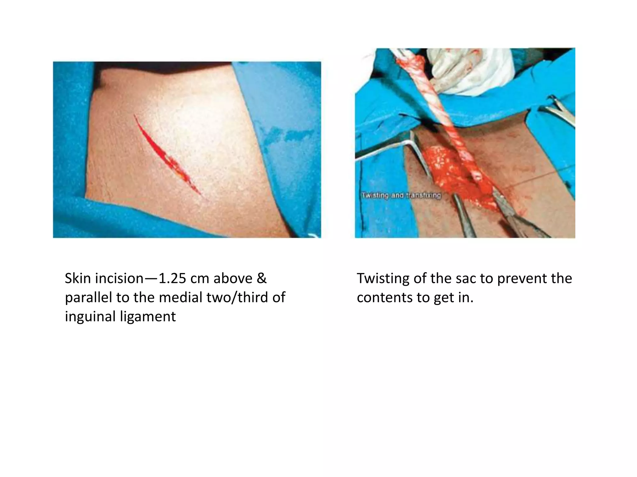 TREATMENT AND MANAGEMENT OF HERNIA | PPTX