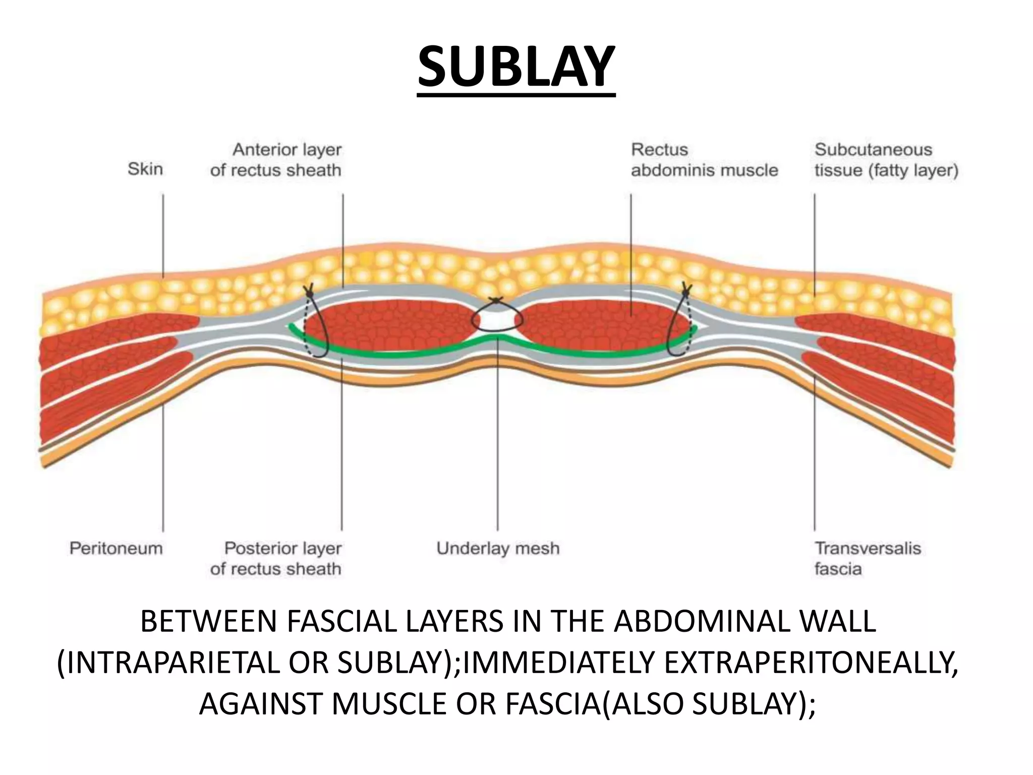 TREATMENT AND MANAGEMENT OF HERNIA | PPTX