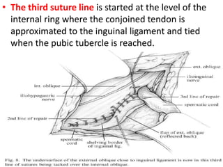 TREATMENT AND MANAGEMENT OF HERNIA | PPTX