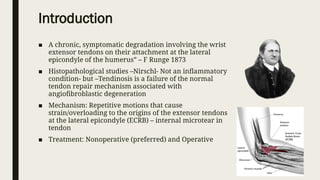 TREATMENT OF LATERAL EPICONDYLITIS managing | PPTX