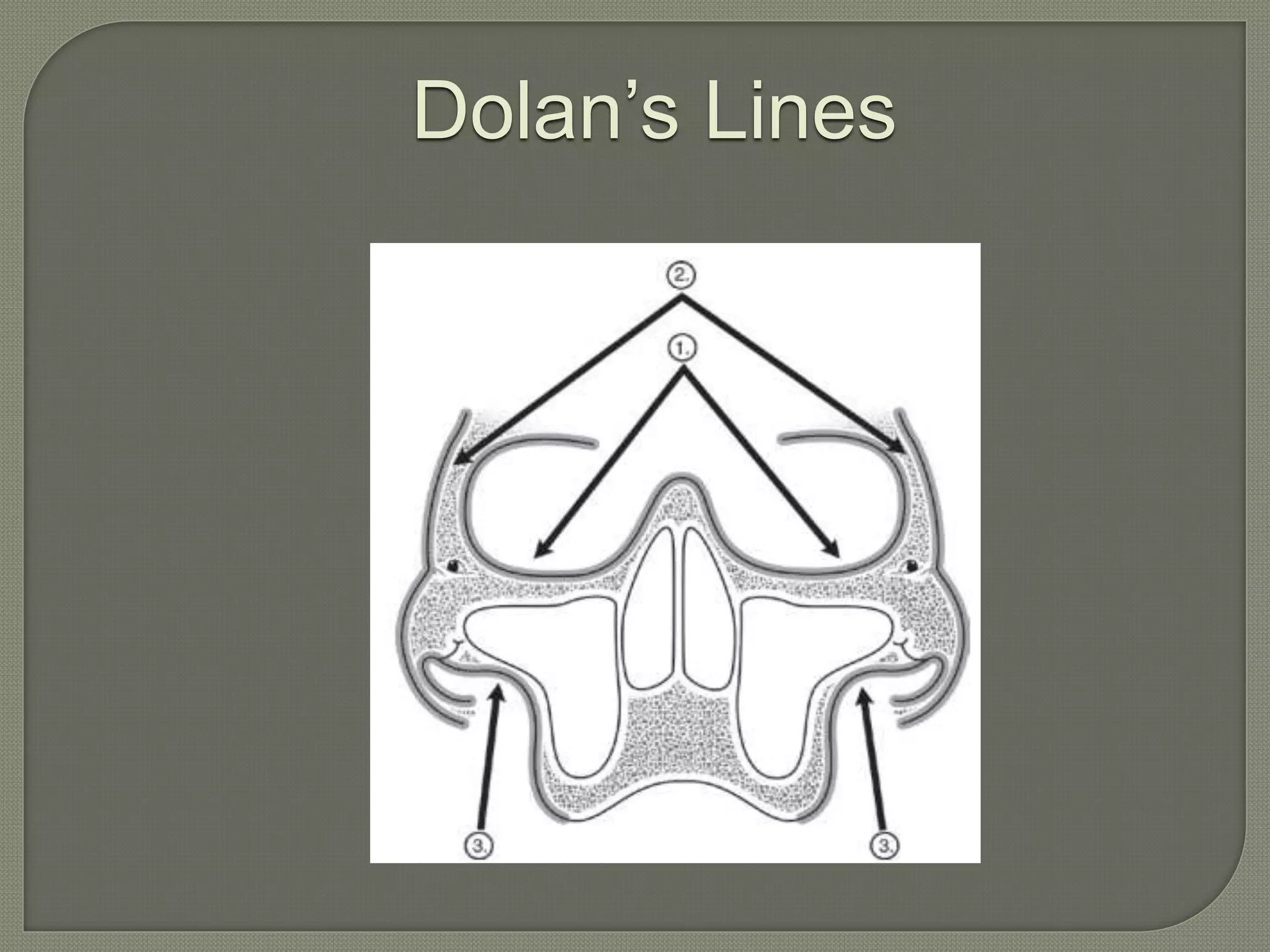 Treatment of le fort fractures.pptx