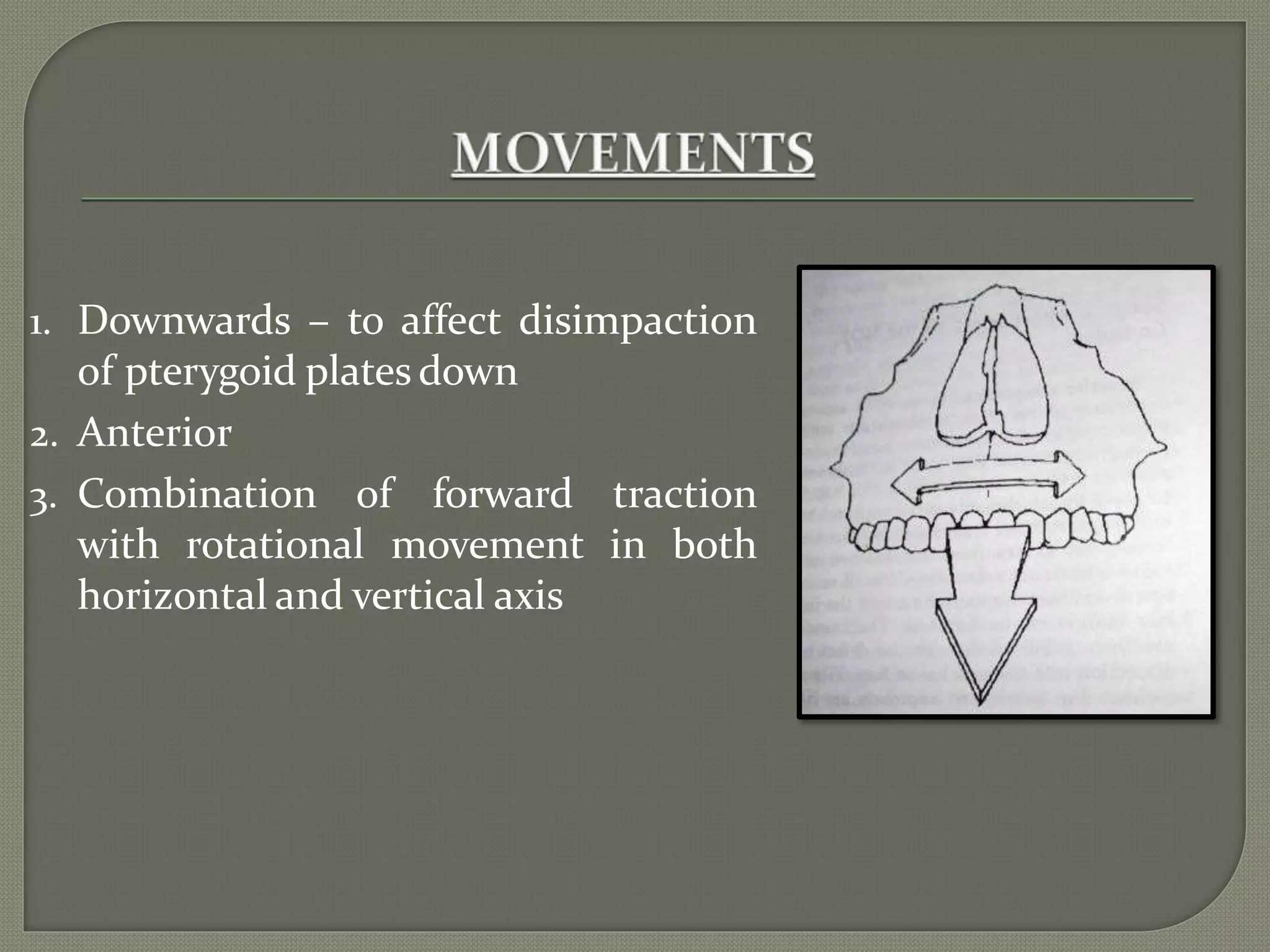 Treatment of le fort fractures.pptx