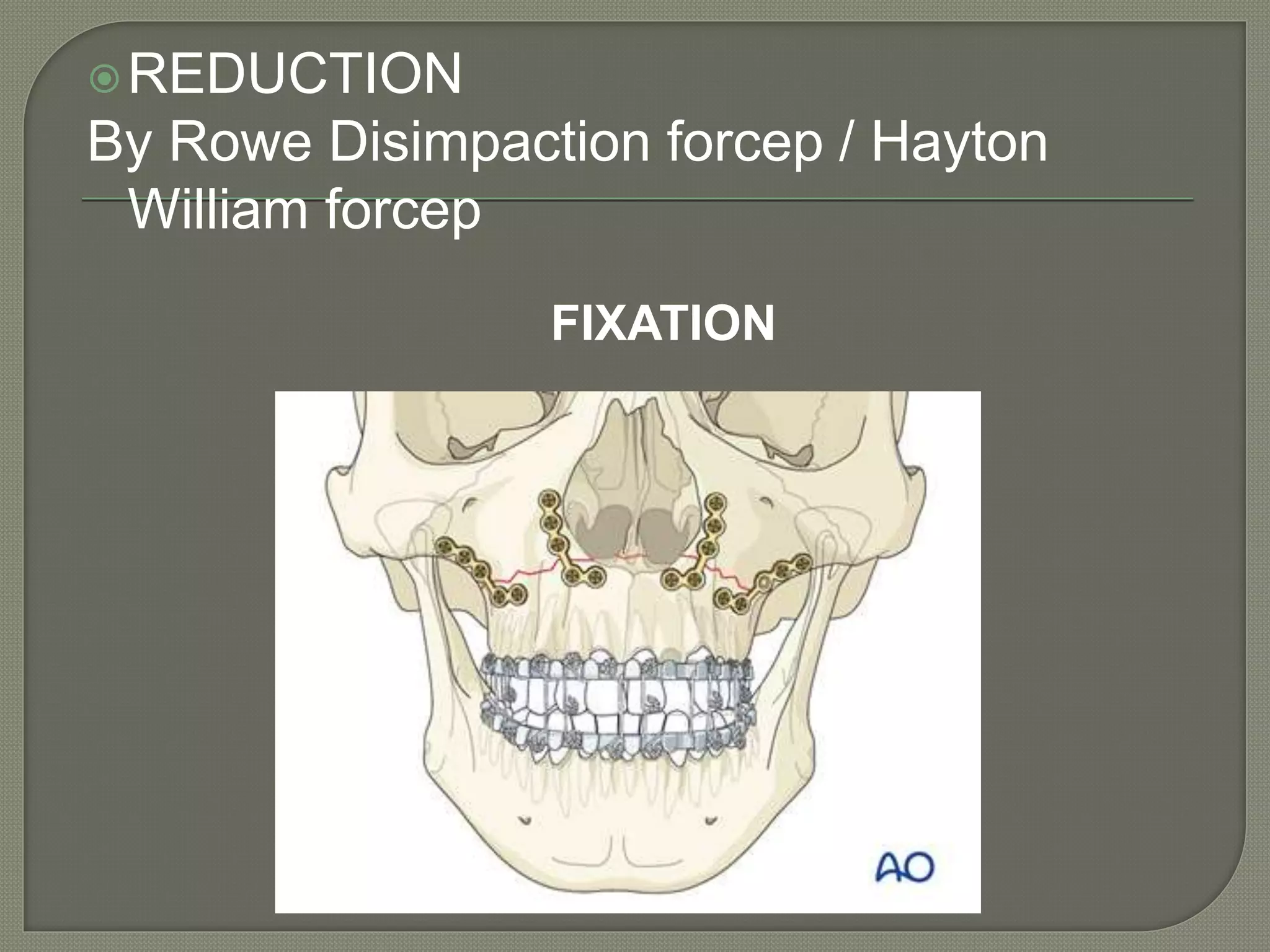 Treatment of le fort fractures.pptx