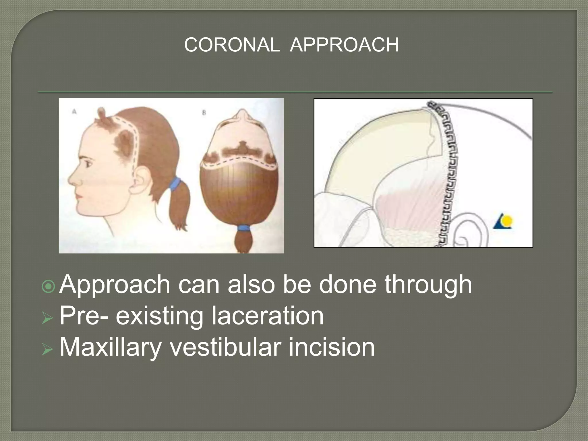 Treatment of le fort fractures.pptx
