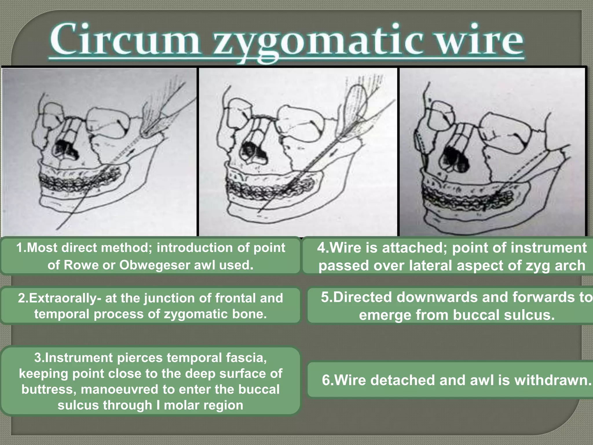 Treatment of le fort fractures.pptx