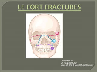 Treatment of le fort fractures.pptx