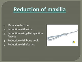 Treatment of le fort fractures.pptx