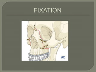 Treatment of le fort fractures.pptx