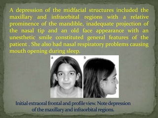 Treatment of maxillary deficiency by miniplates last | PPTX