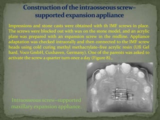 Treatment of maxillary deficiency by miniplates last | PPTX