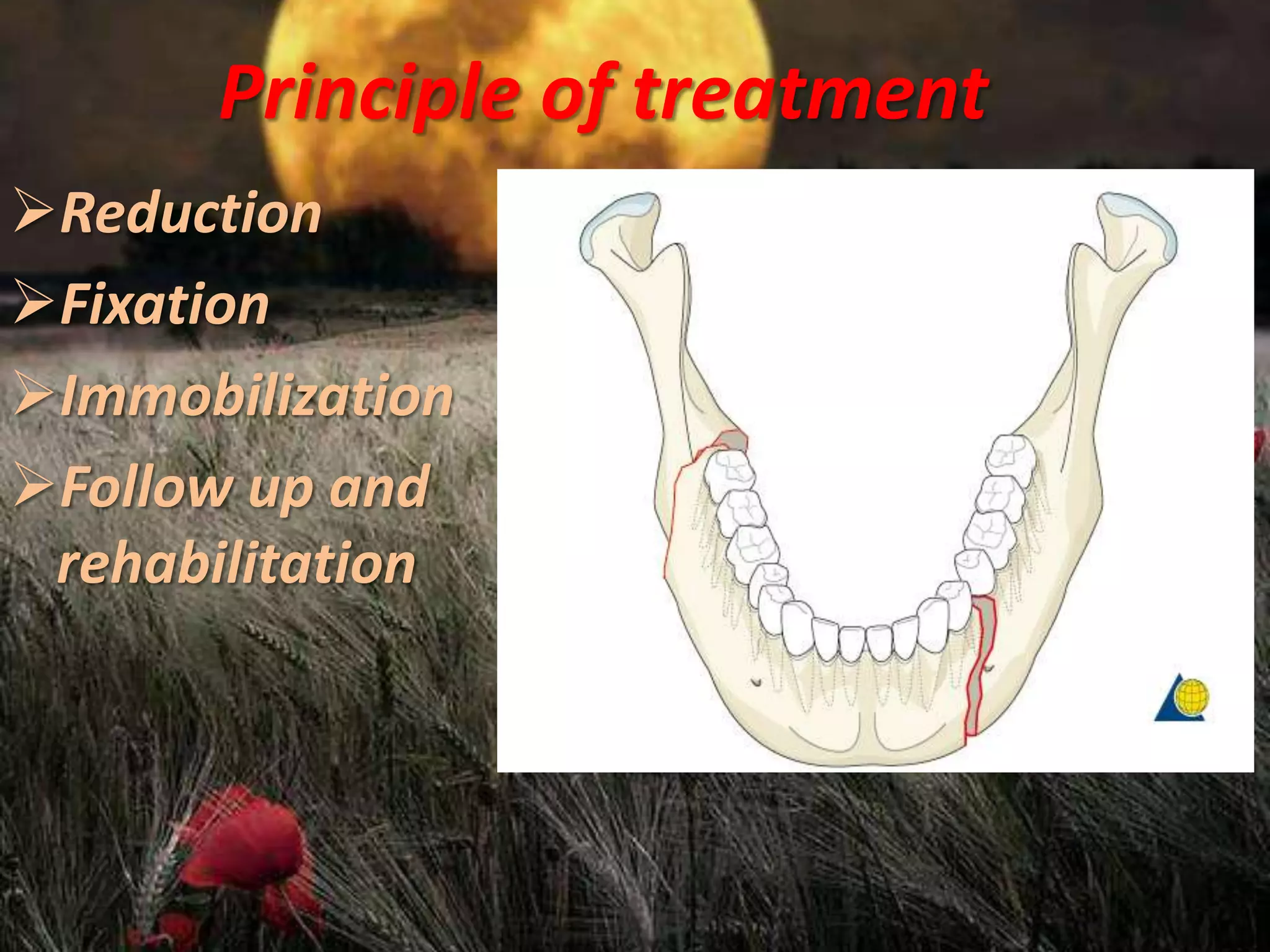 Treatment of midface fracture | PPSX