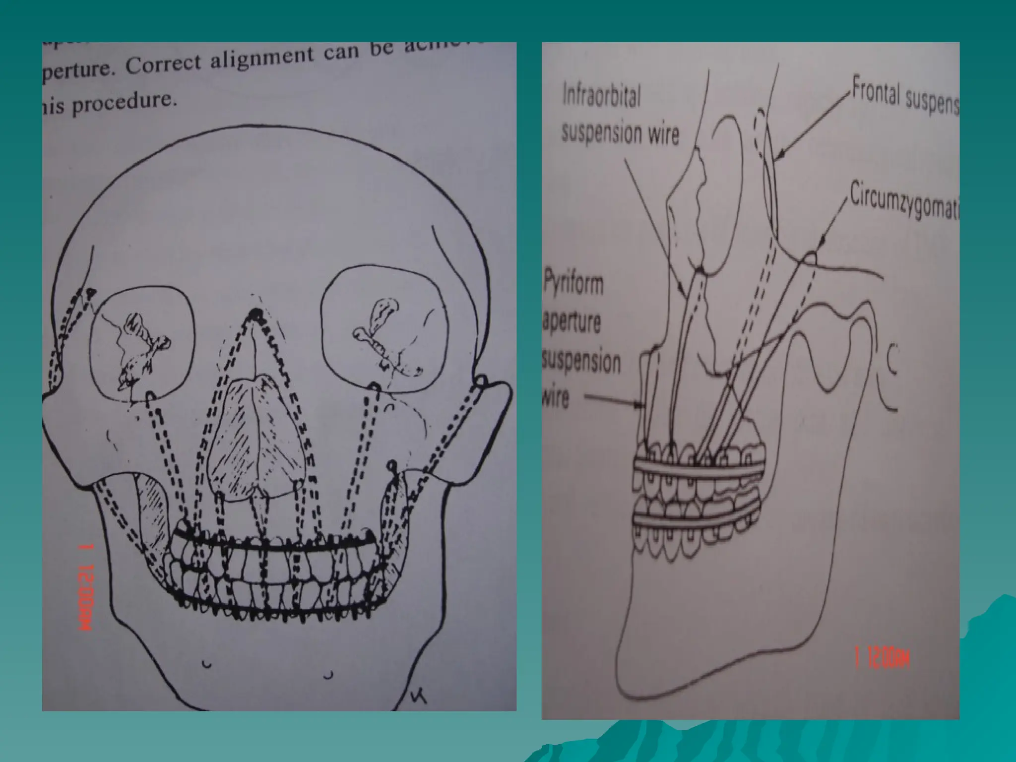 Treatment of Maxillary bone fractures.ppt
