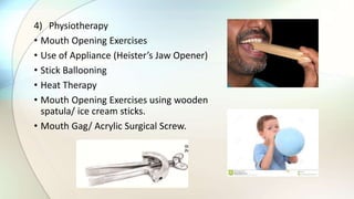 Treatment of oral submucous fibrosis | PPTX