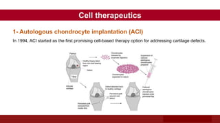 Treatment of osteochondral lesions. past, present and future. | PPTX ...
