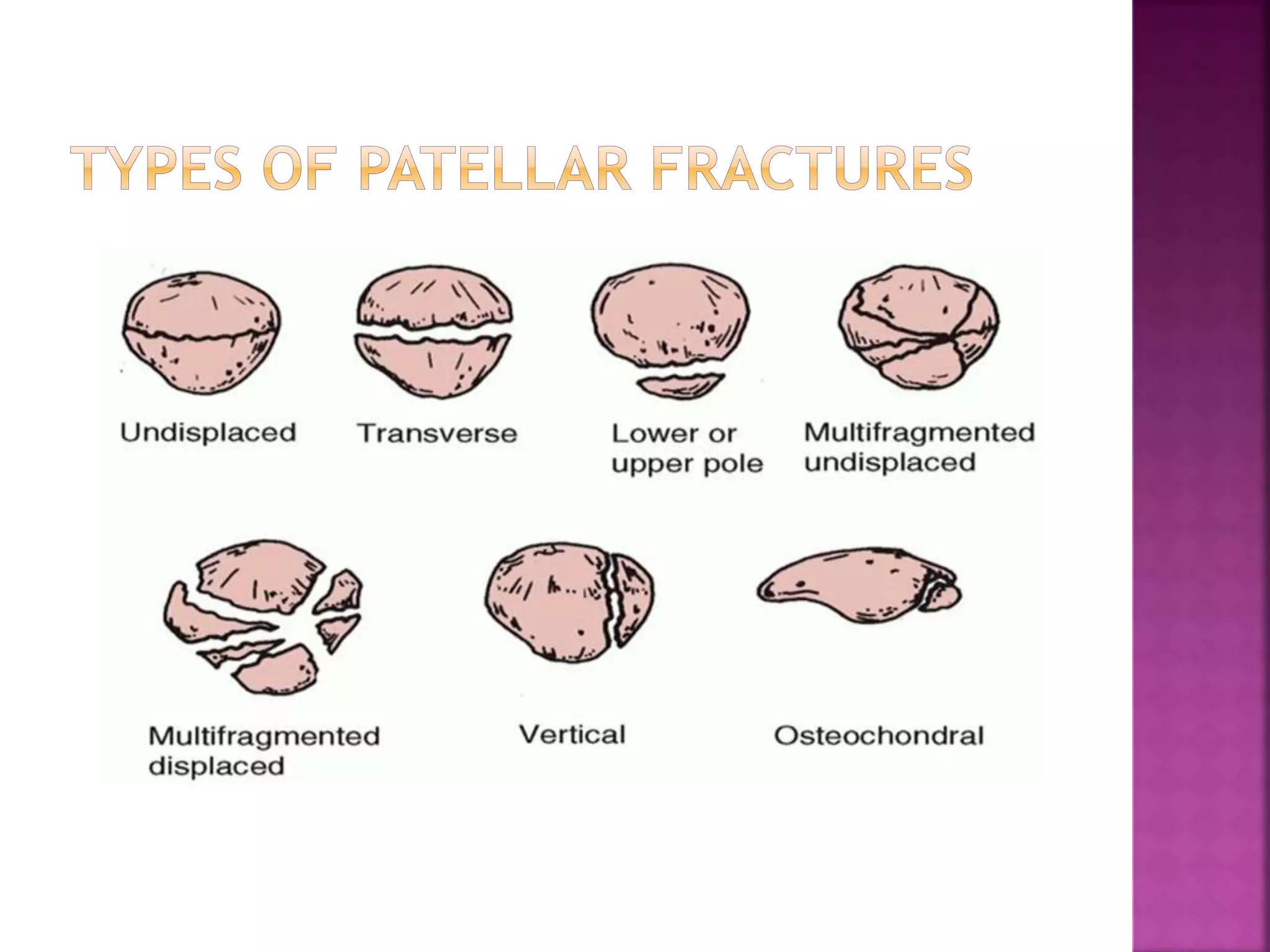 Treatment of patellar fracture | PPTX