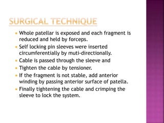 Treatment of patellar fracture | PPTX