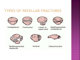 Patella Fracture Classification
