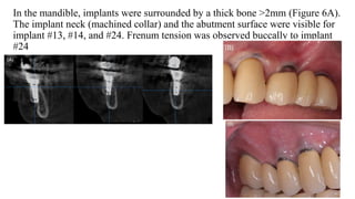 TREATMENT OF PERI-IMPLANT SOFT TISSUE DEHISCENCE AROUND IMPLANTS.pptx