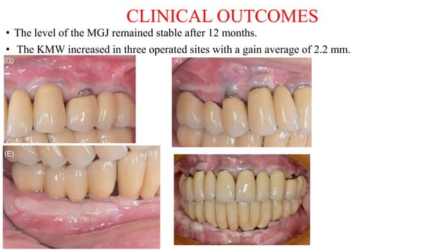 TREATMENT OF PERI-IMPLANT SOFT TISSUE DEHISCENCE AROUND IMPLANTS.pptx