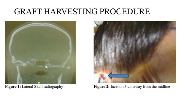 TREATMENT OF PERI-IMPLANT SOFT TISSUE DEHISCENCE AROUND IMPLANTS.pptx