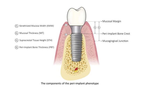 TREATMENT OF PERI-IMPLANT SOFT TISSUE DEHISCENCE AROUND IMPLANTS.pptx