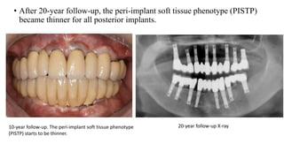 TREATMENT OF PERI-IMPLANT SOFT TISSUE DEHISCENCE AROUND IMPLANTS.pptx