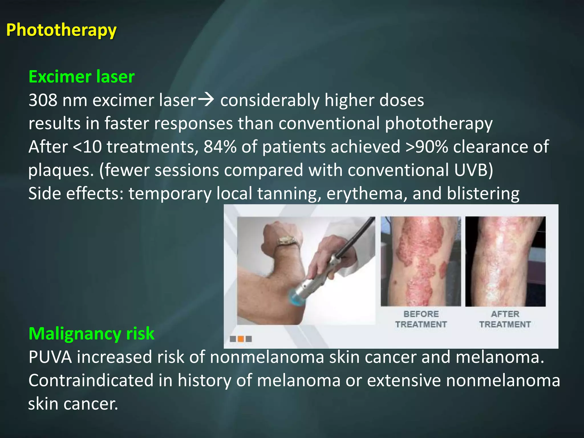 Treatment of psoriasis | PPTX