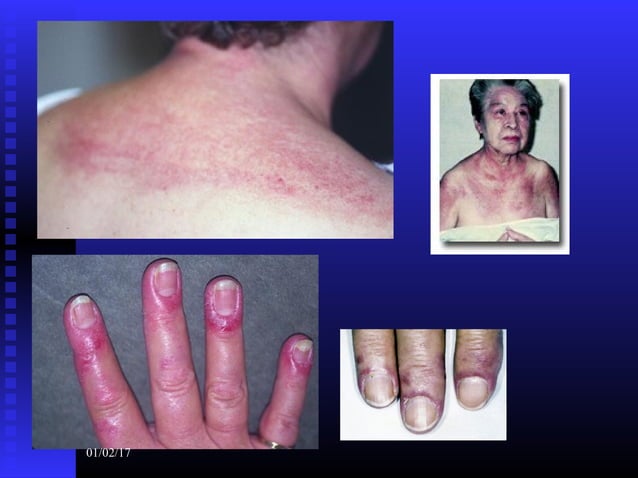 Treatment of recurrent and resistant dermatomyositis and polymyositis ...