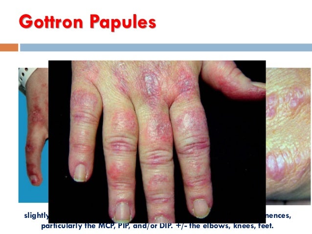 Treatment of resistant & relapsing polymyositis dm
