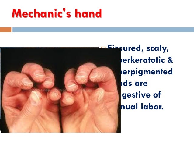 Treatment of resistant & relapsing polymyositis dm