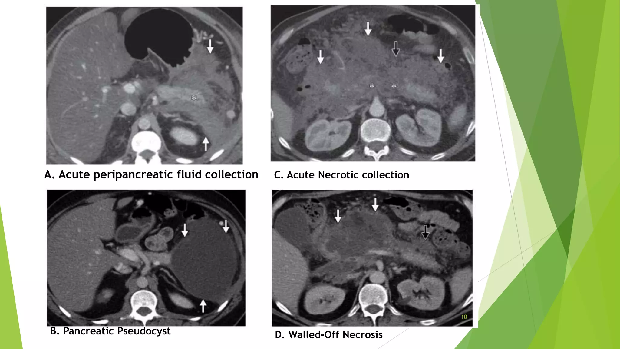 Treatment of severe acute pancreatitis and its complications.pptx