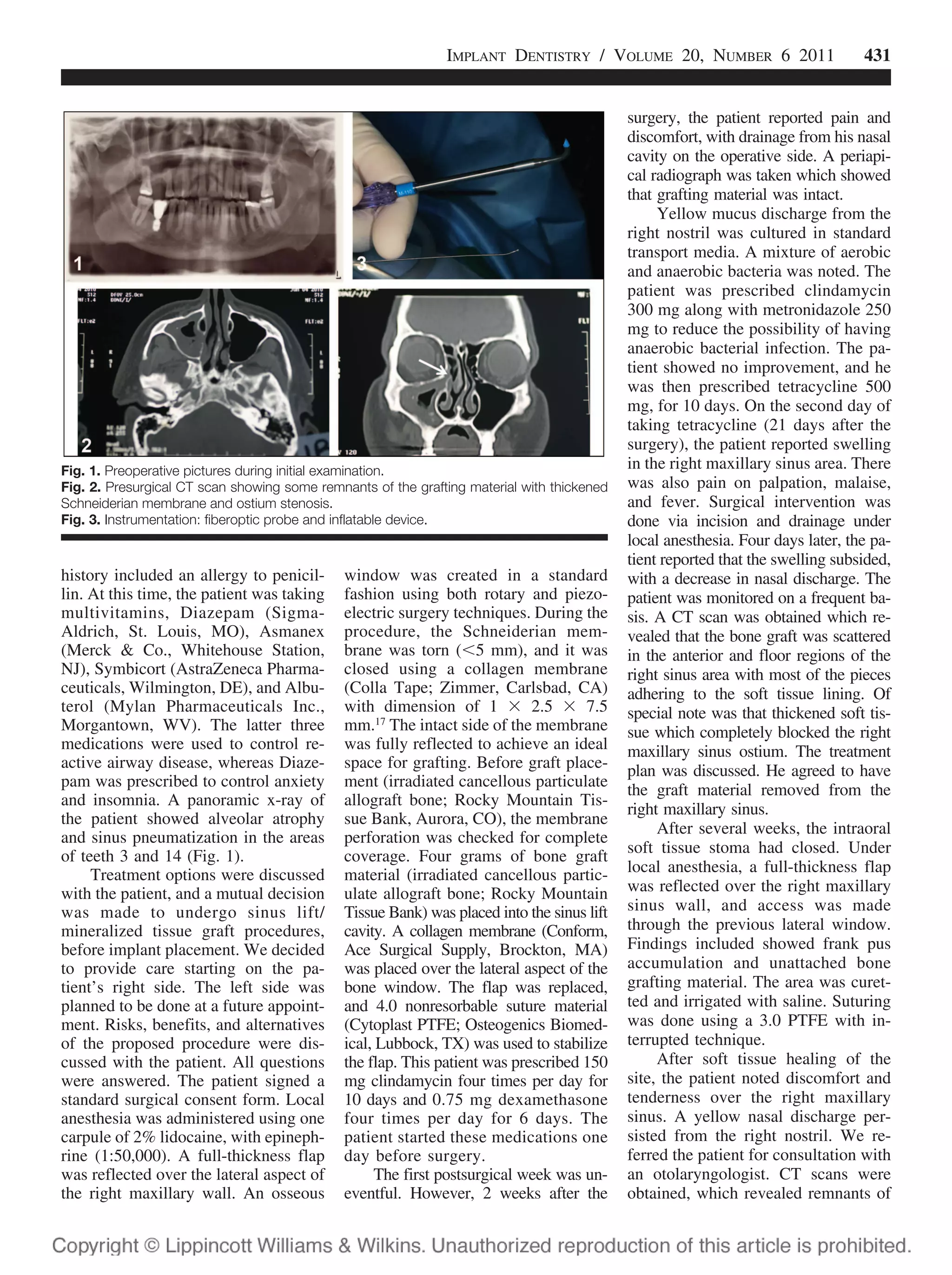 Treatment of severe sinus infection after sinus lift procedure a case ...