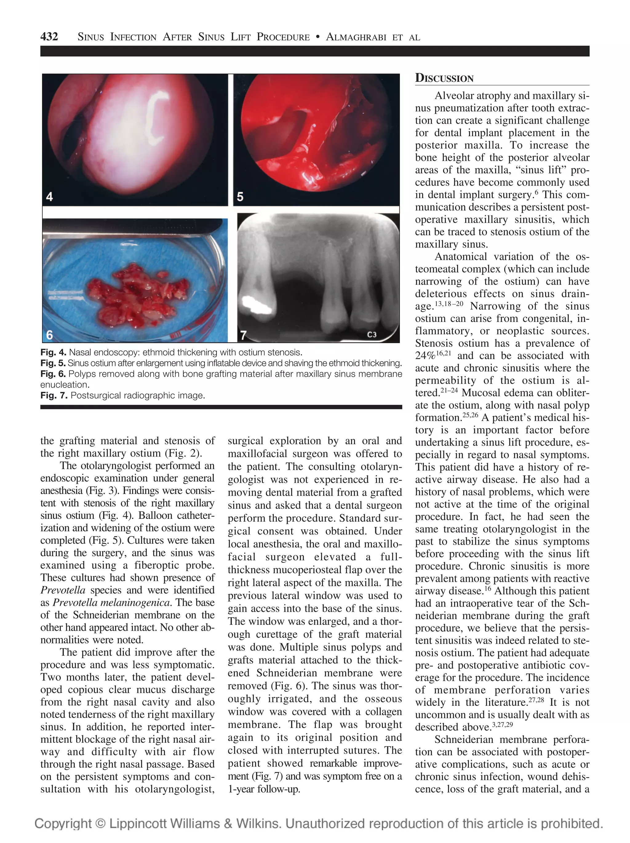 Treatment of severe sinus infection after sinus lift procedure a case ...